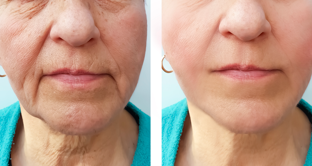 Ageless before and after image 6 Anti Age Naturally Ageless before and after image 6 Anti Age Naturally